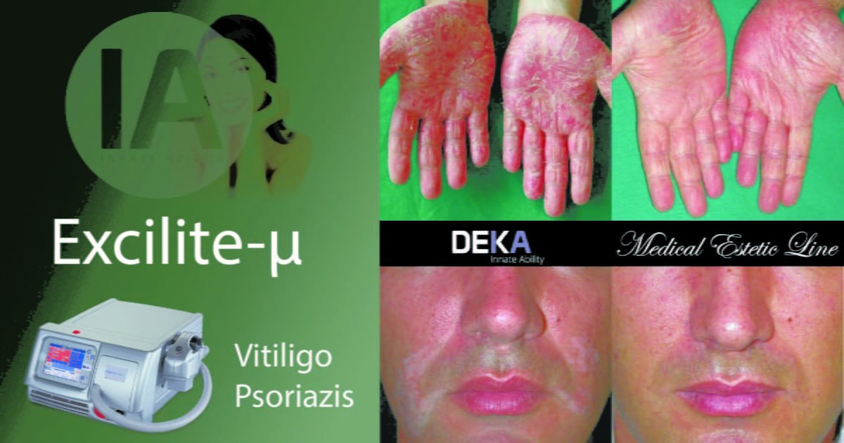 DEKA Laser Excilite μ | Laser Vitiligo Psoriazis | Medical Estetic Line