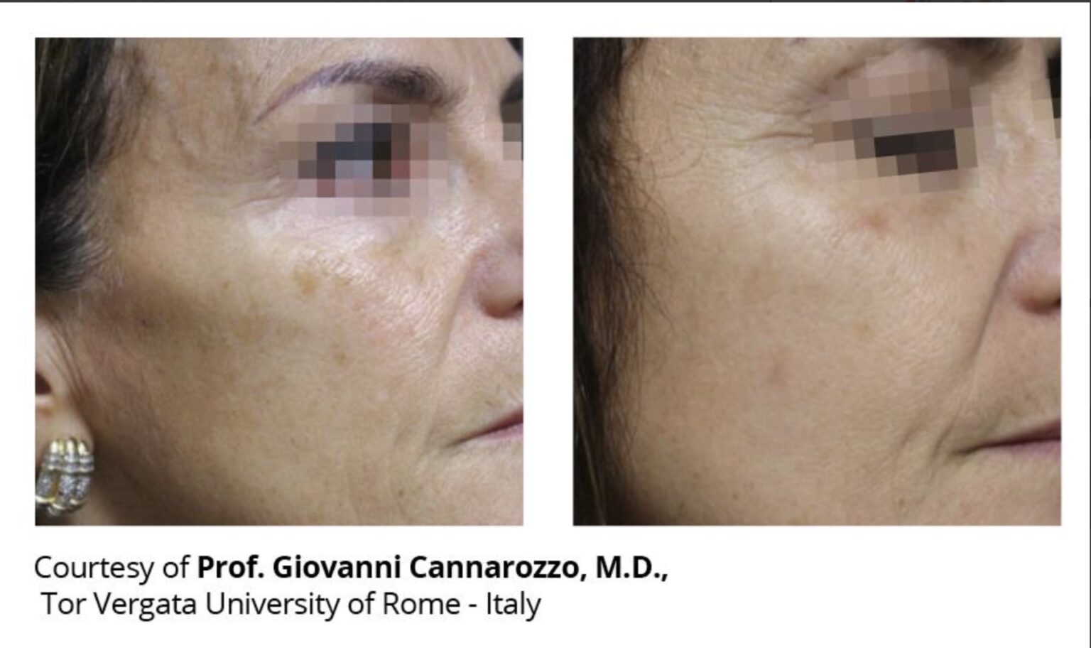 RedTouch | DEKA Laser | Unic Importator România | Medical Estetic Line